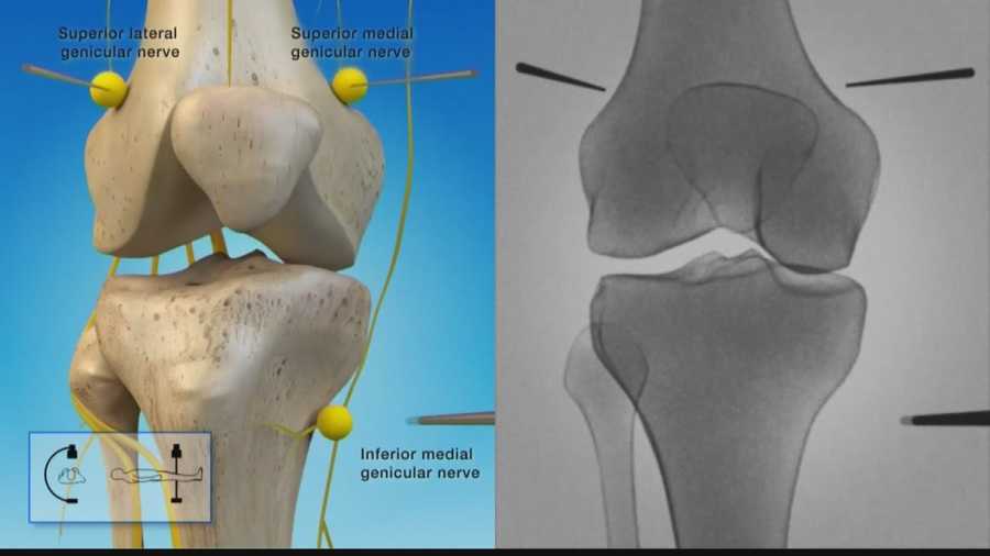 Coolief treatment can relieve knee pain