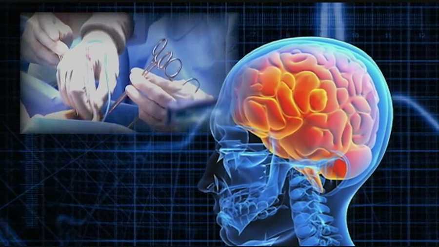 Revolutionary brain surgery procedure taking place in South Florida